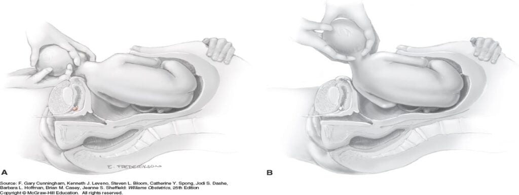 CS – Delivery – Rural Surgery & Obstetrics