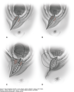 Types and Approaches to Repair – Rural Surgery & Obstetrics